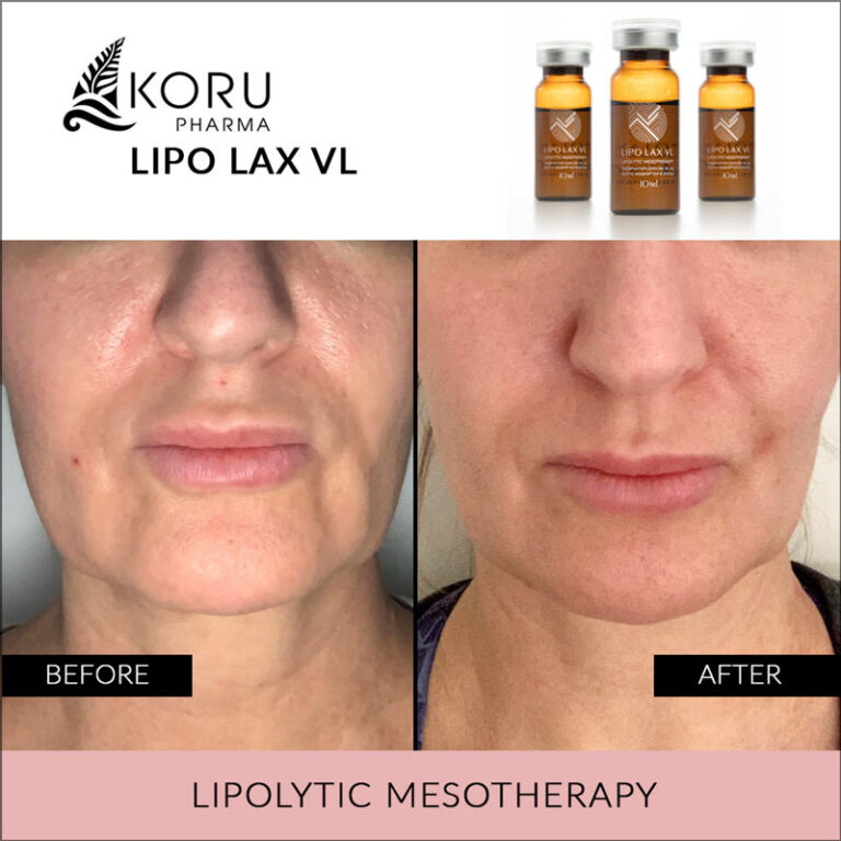 KORU PHARMA LIPO LAX VL fat dissolving Lipolytic Mesotherapy product