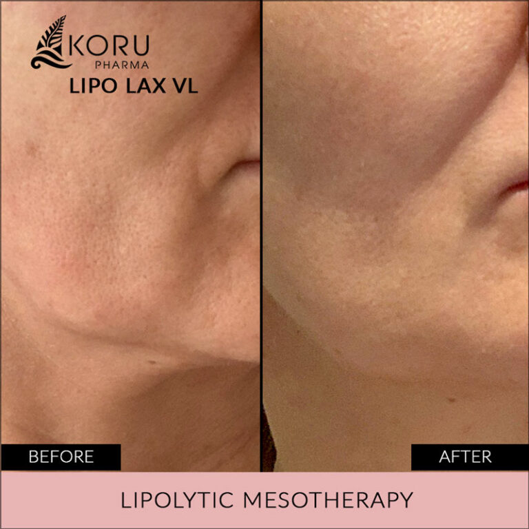 KORU PHARMA LIPO LAX VL fat dissolving Lipolytic Mesotherapy product