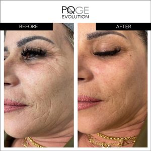 Promoitalia PQAge Evolution Plus - regenerationg & lifting peeling