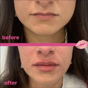 Promoitalia Skinfill Bacio hydrating lip booster