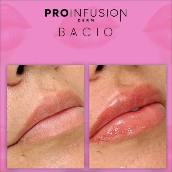 Promoitalia Pro Infusion BACIO Tips - Single Use Sterile