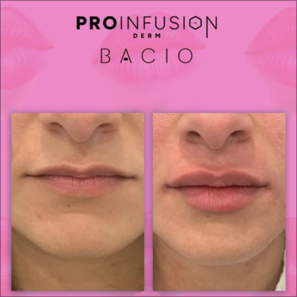 Promoitalia Pro Infusion BACIO Tips - Single Use Sterile